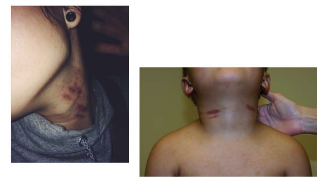 Mechanical injuries.pptx | First Aid | Injuries