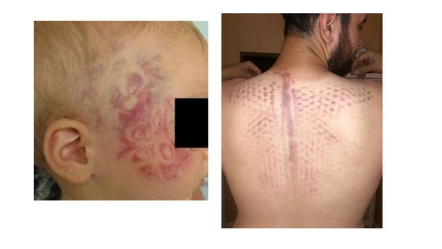 Mechanical injuries.pptx | First Aid | Injuries