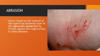 MECHANICAL INJURIES in forensic Medicine | PPT