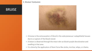 MECHANICAL INJURIES in forensic Medicine | PPTX