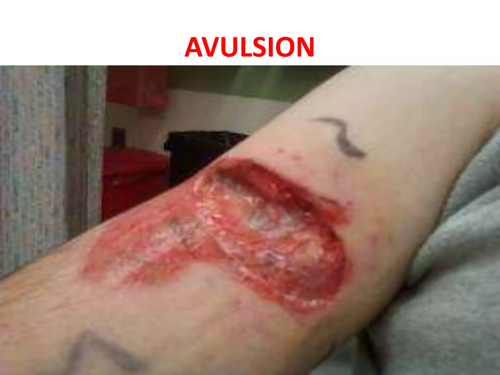 MECHANICAL INJURIES - LACERATIONS.pptx