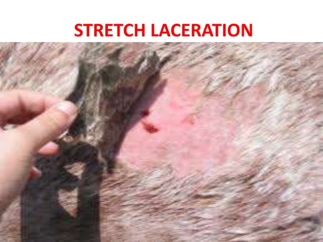 MECHANICAL INJURIES - LACERATIONS and types.pptx | Death, Injury, or ...