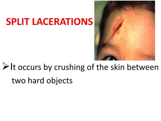 MECHANICAL INJURIES - LACERATIONS and types.pptx | Death, Injury, or ...