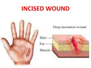 Mechanical injuries(ICS) due to sharp force.ppt