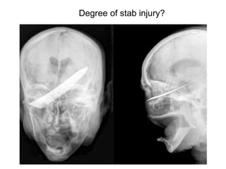 Mechanical injuries(ICS) due to sharp force.ppt