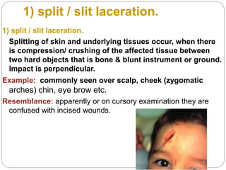 Split Laceration