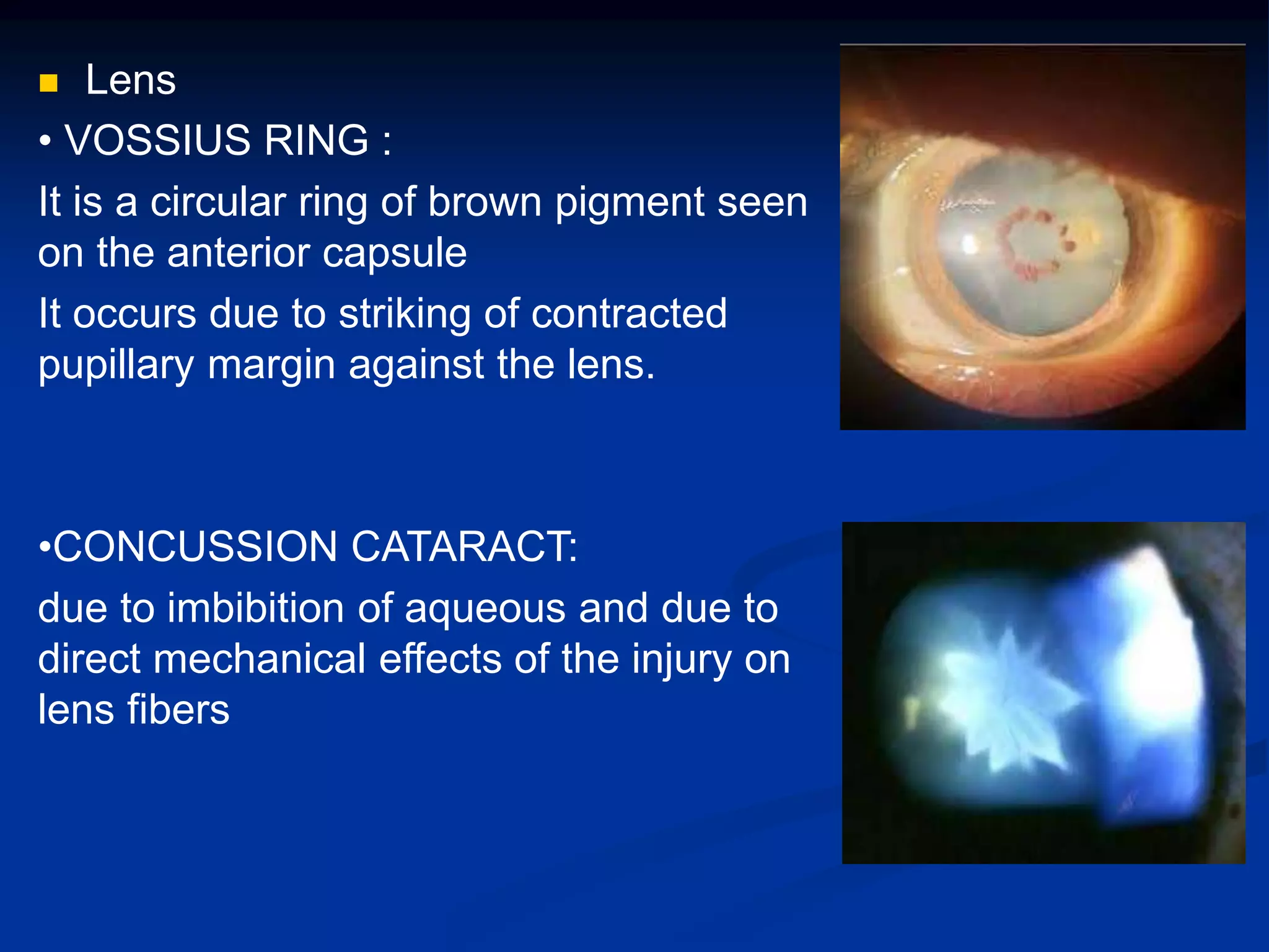 Mechanical_ocular_trauma.pptx