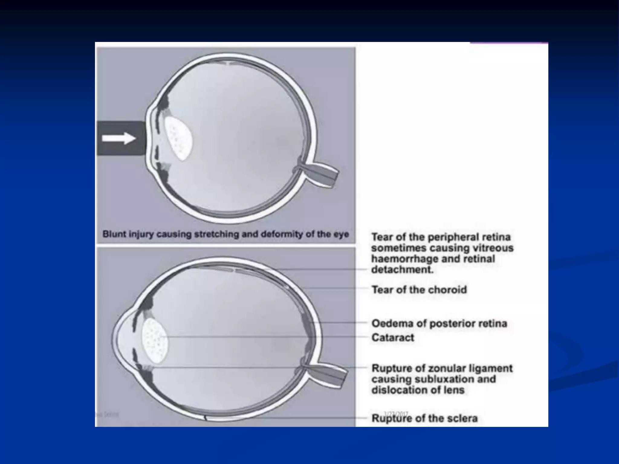Mechanical_ocular_trauma.pptx