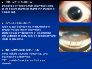 Mechanical_ocular_trauma.pptx