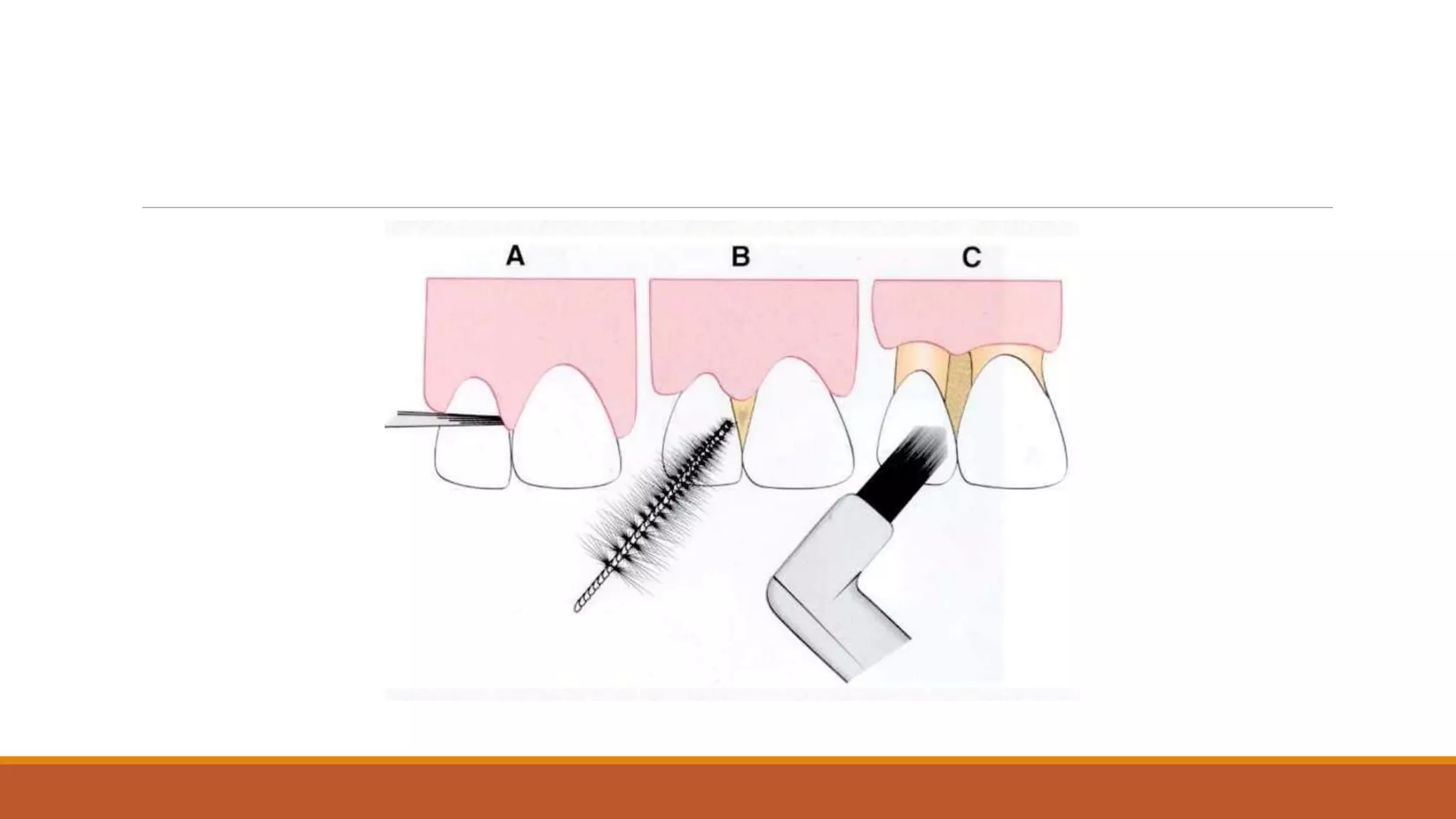 Mechanical plaque control | PPTX