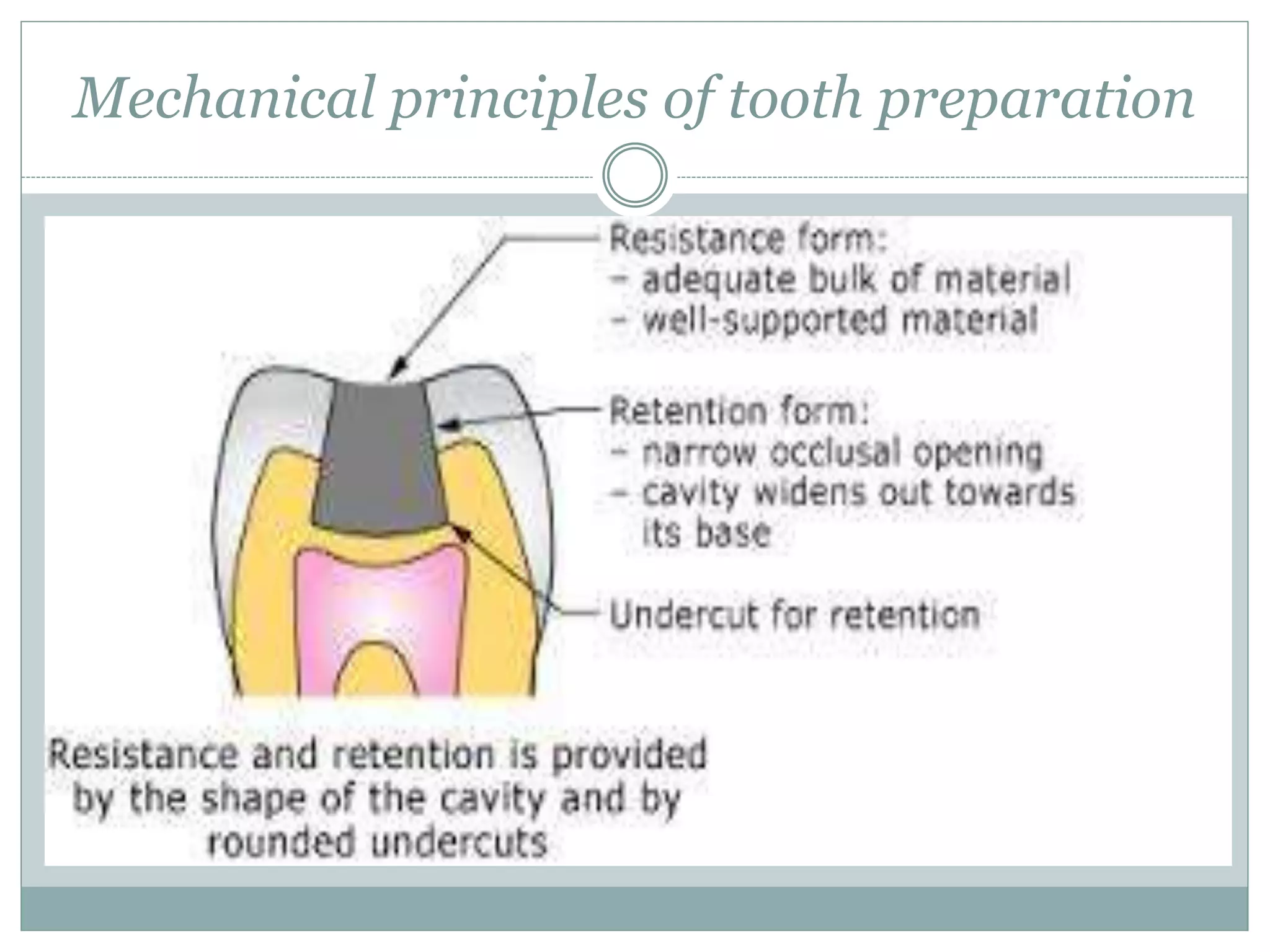 Mechanical principles of tooth preparation | PPTX