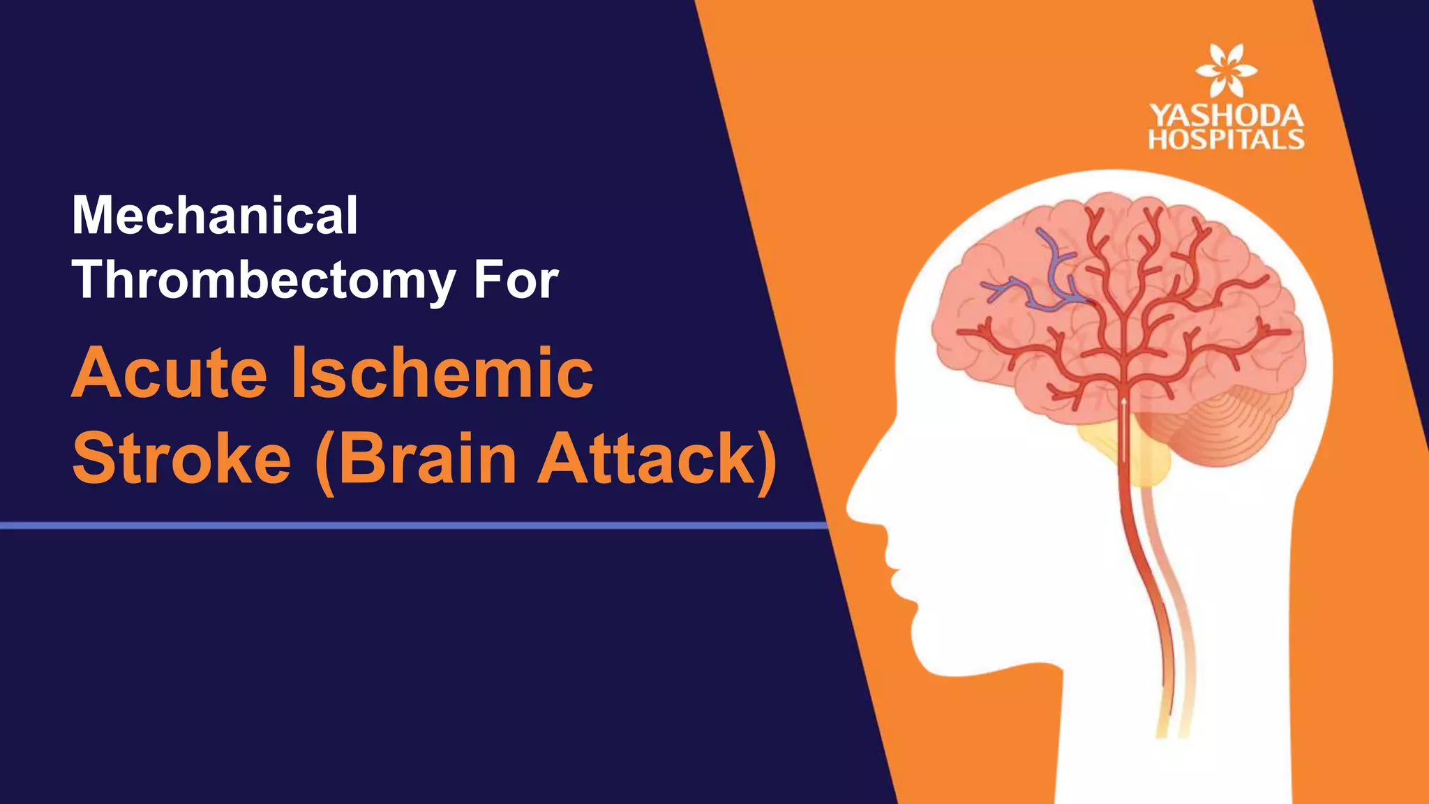 Mechanical Thrombectomy for Acute Ischemic Stroke | Brain Stroke ...
