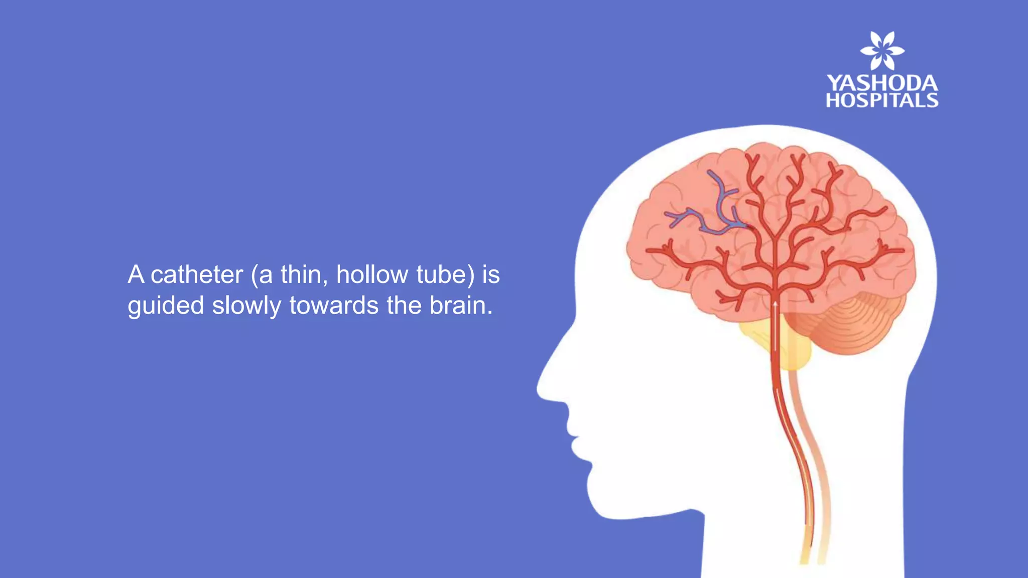 Mechanical Thrombectomy for Acute Ischemic Stroke | Brain Stroke ...