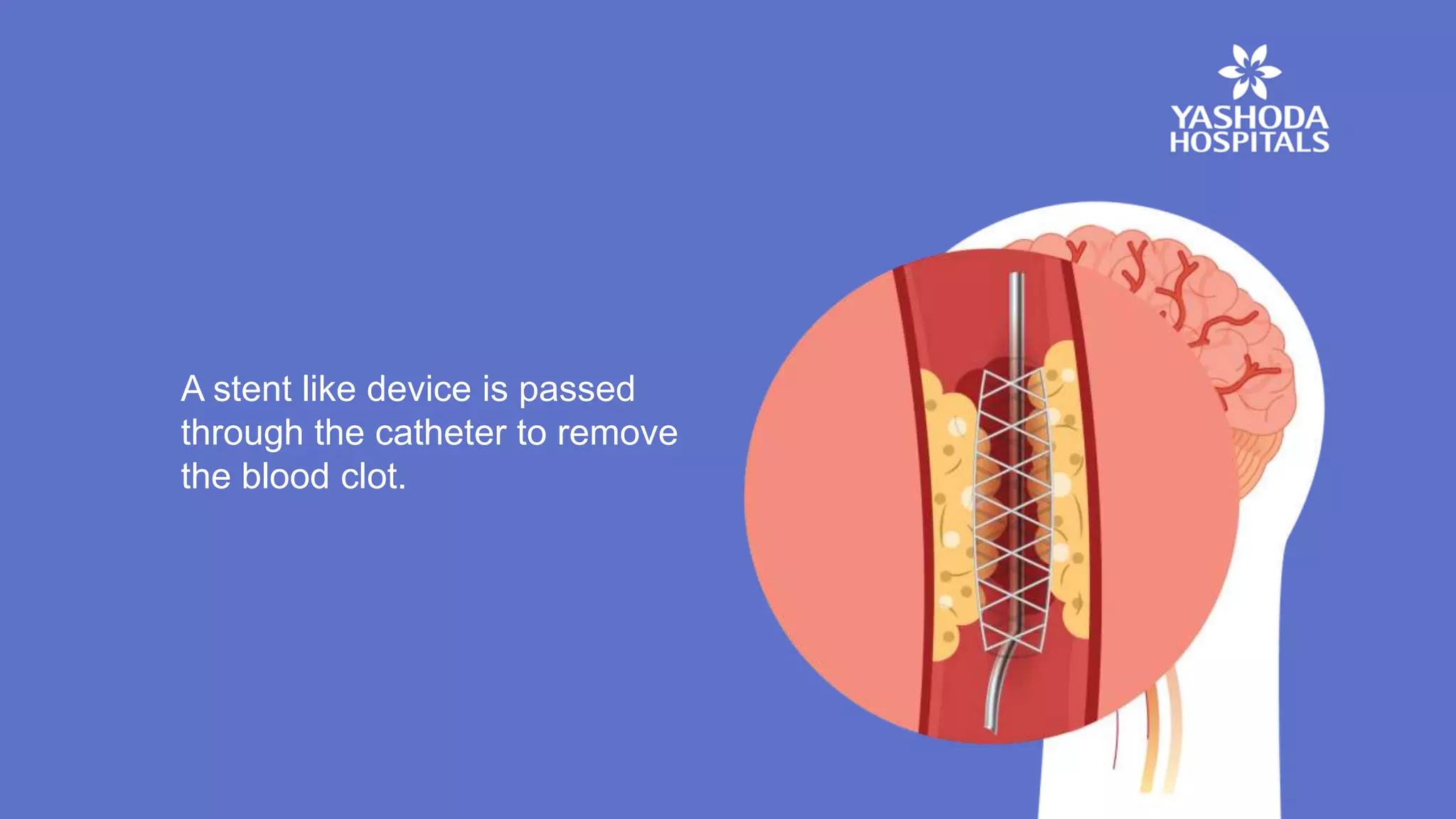 Mechanical Thrombectomy for Acute Ischemic Stroke | Brain Stroke ...