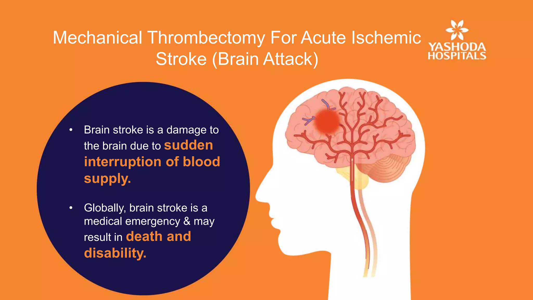 Mechanical Thrombectomy for Acute Ischemic Stroke | Brain Stroke ...