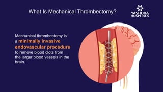 Mechanical Thrombectomy for Acute Ischemic Stroke | Brain Stroke ...