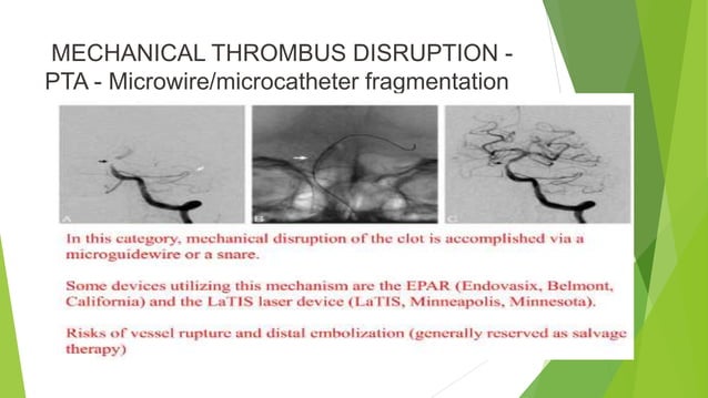 Mechanical thrombectomy in acute stroke [Autosaved].pptx