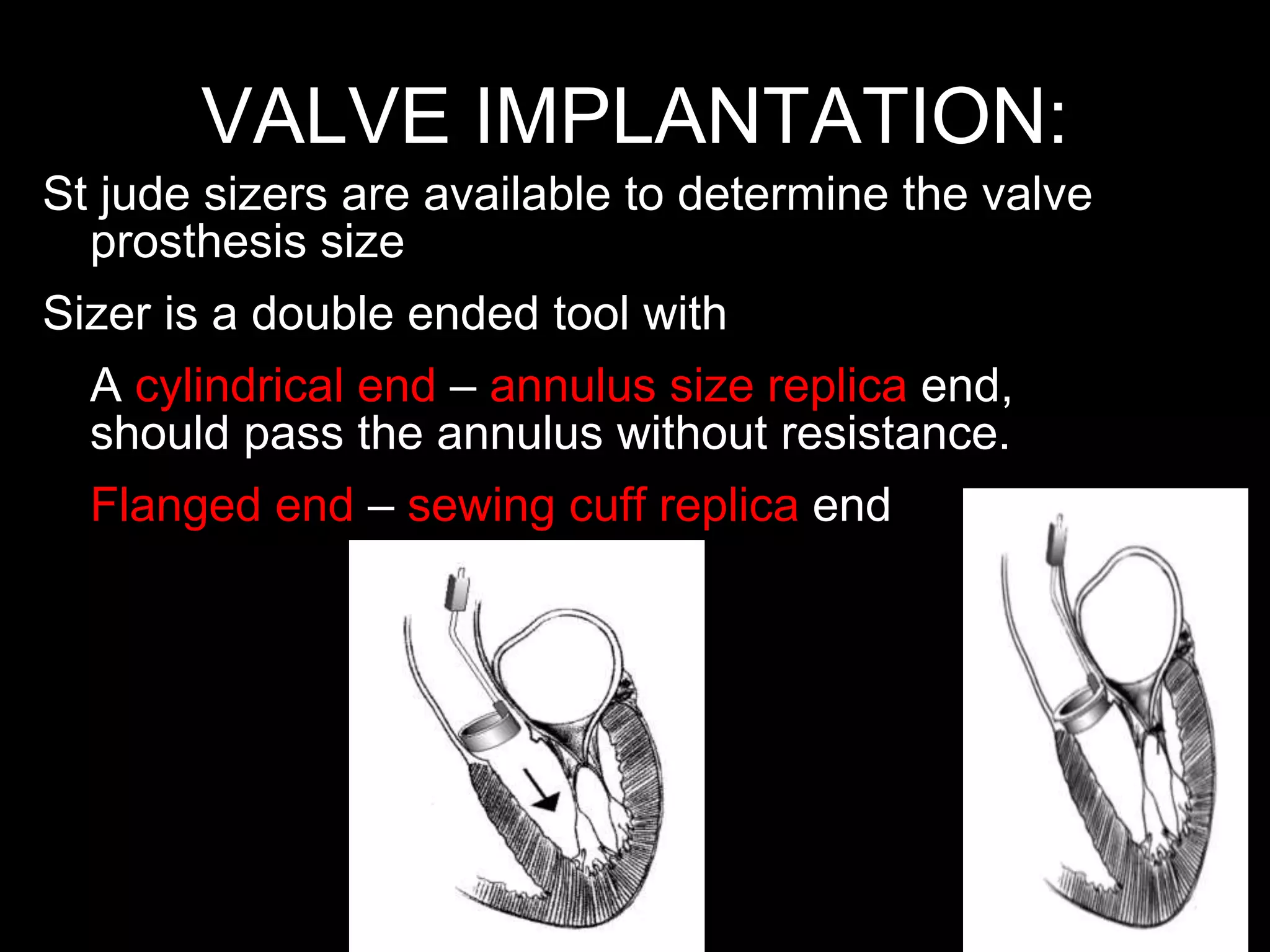 Mechanical valves | PPTX