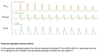 Slideshow on Mechanical Ventilation .pdf