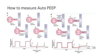 Mechanical ventilation 6- in obstructive airway disease | PPTX