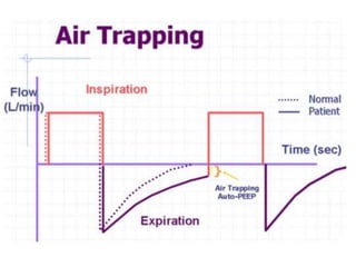 Mechanical ventilation basics | PPTX