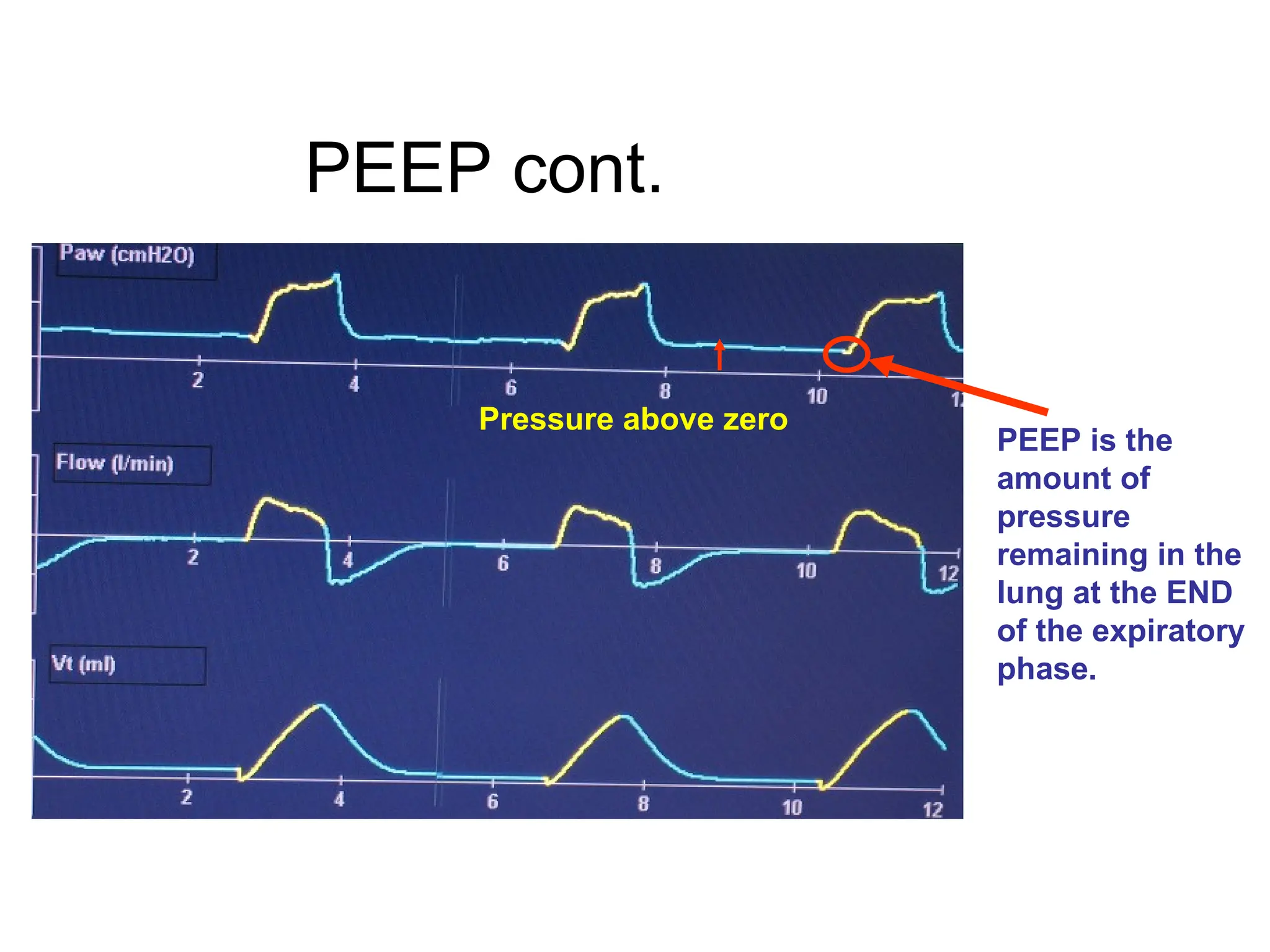 Mechanical Ventialtion for Nursing Cares | PPT