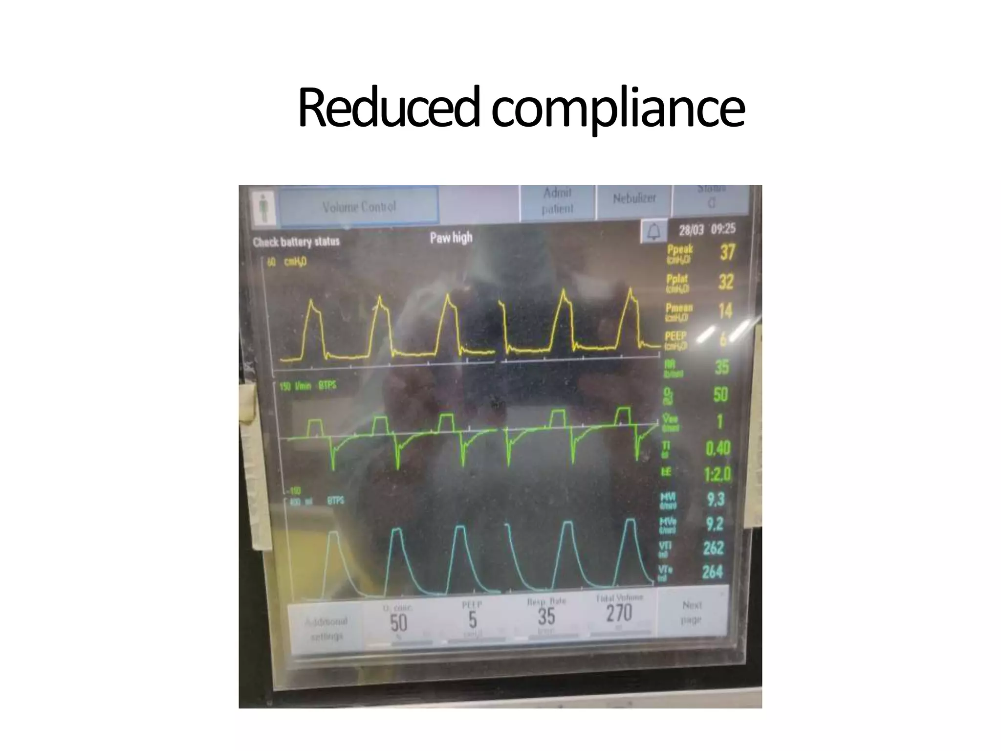 Mechanical ventilation Basics and waveforms | PPTX | Lung and ...
