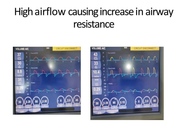 Mechanical ventilation Basics and waveforms | PPTX | Lung and ...