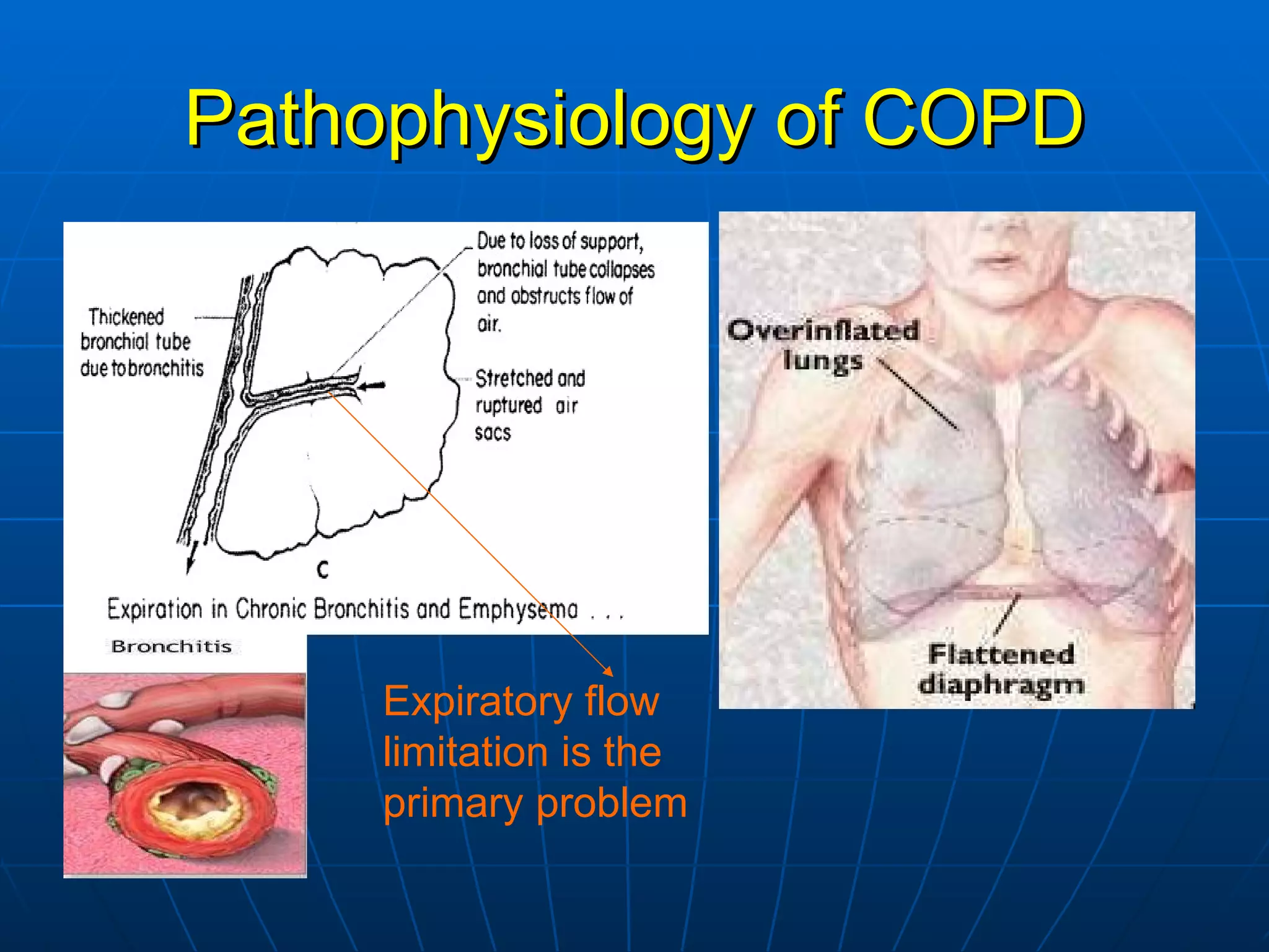 Mechanical ventilation in COPD Asthma drtrc | PPT