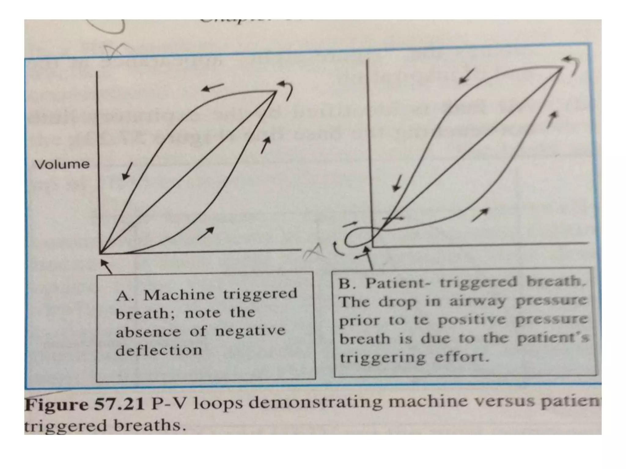 Mechanical ventilation in neonates by dr naved akhter | PPT