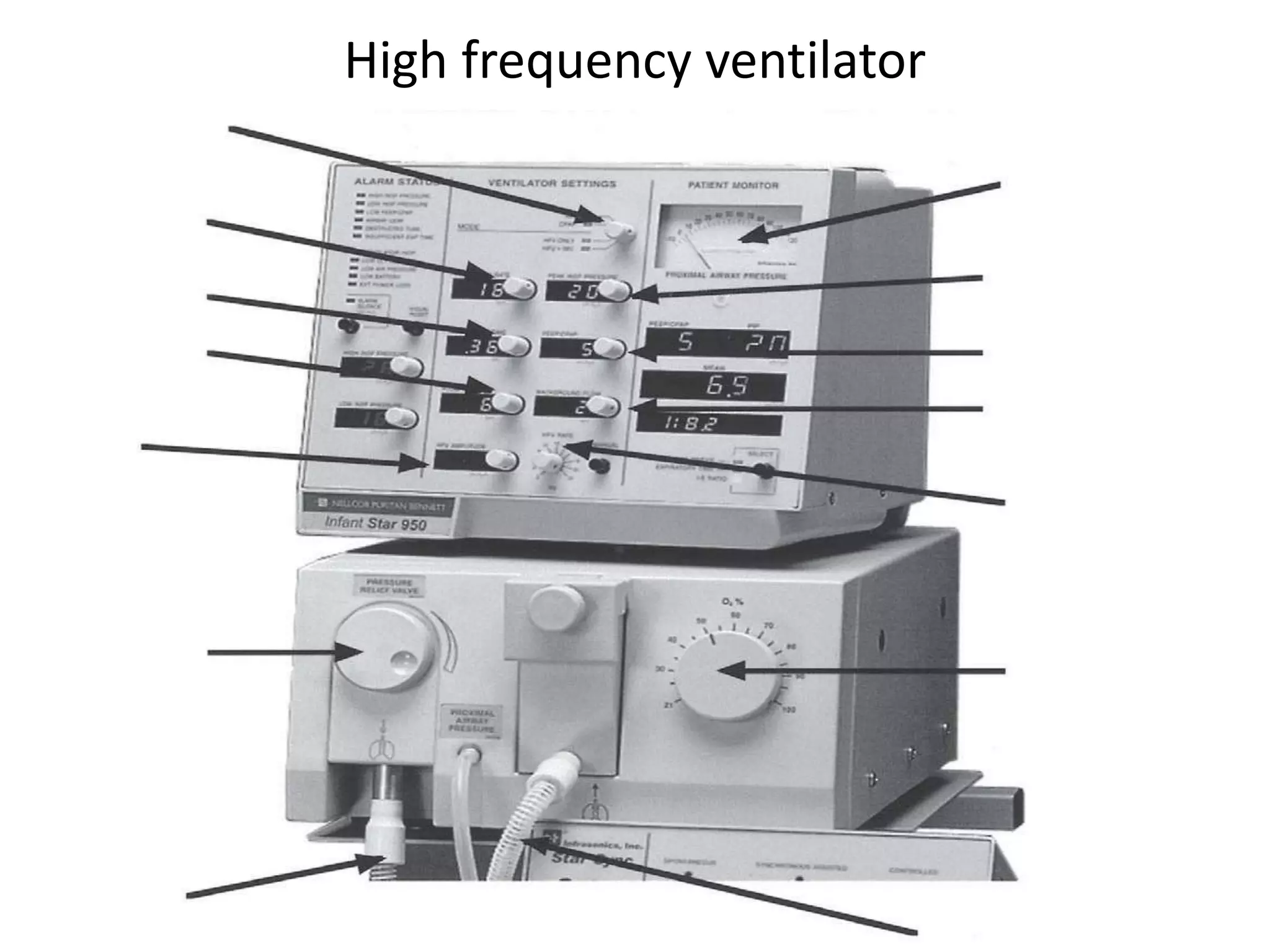 Mechanical ventilation in neonates by dr naved akhter | PPT