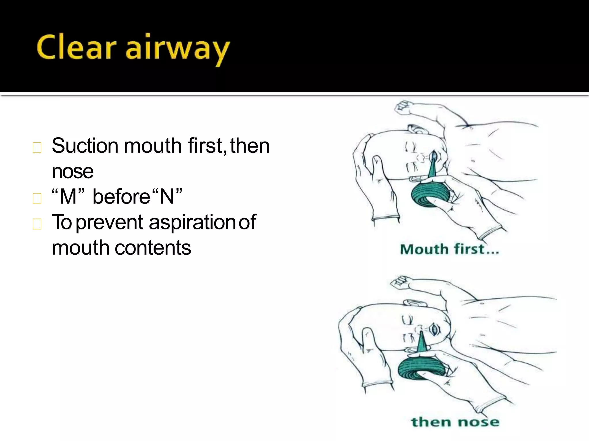 Mechanical ventilation & intubation for neonates | PPTX
