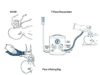 Mechanical ventilation & intubation for neonates | PPTX