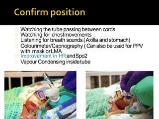 Mechanical ventilation & intubation for neonates | PPTX