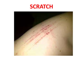 MECHANICLINJURIESABSIONCONTUSON-laceration, incised etc | PPTX