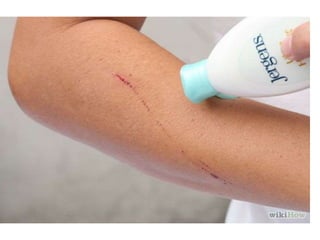 MECHANICLINJURIESABSIONCONTUSON-laceration, incised etc | PPTX