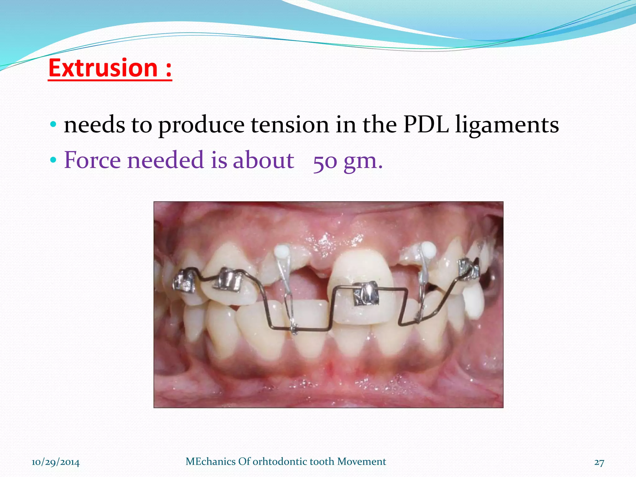 Mechanics of Orthodontic tooth movement | PPTX