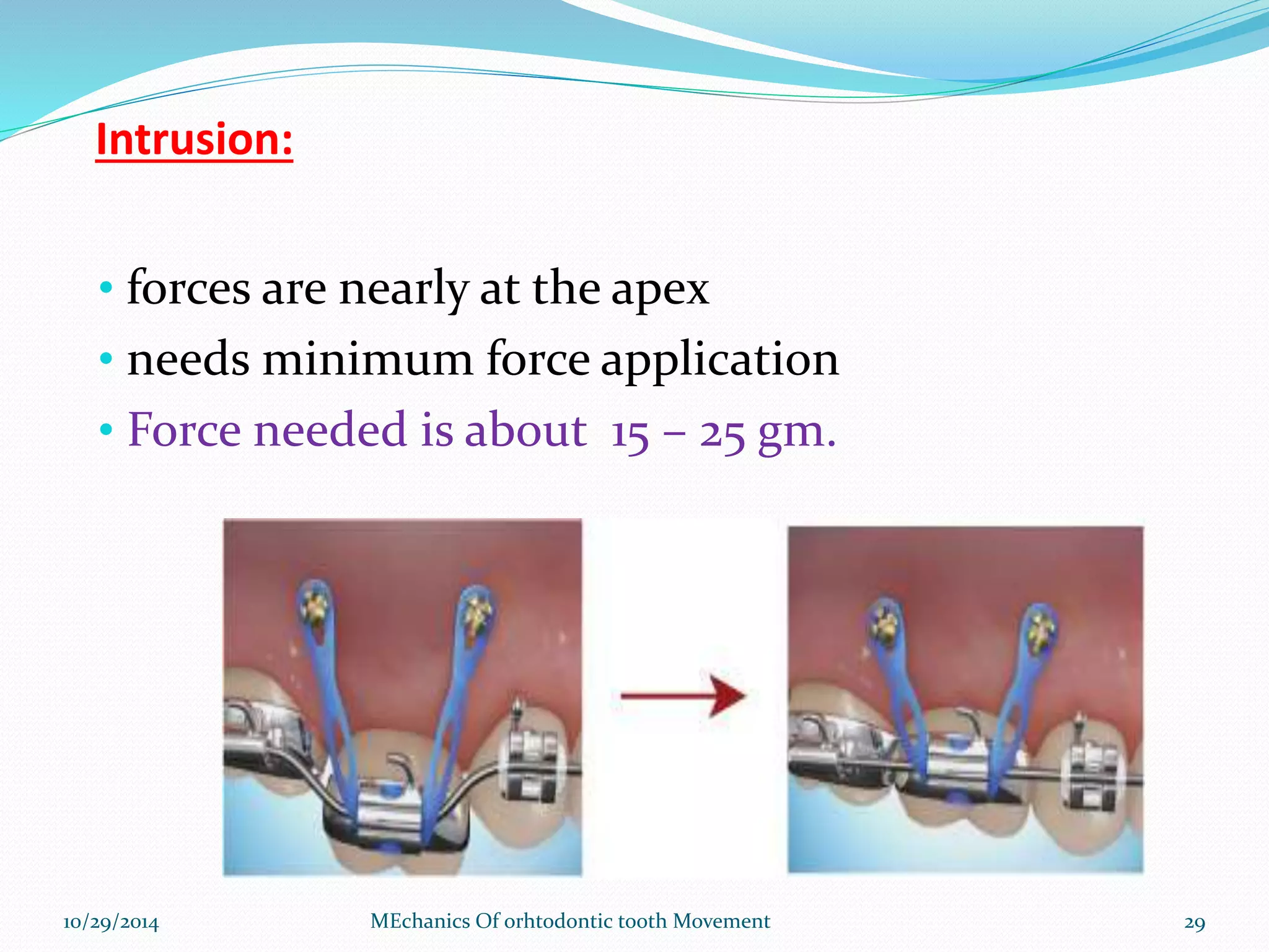 Mechanics of Orthodontic tooth movement | PPTX