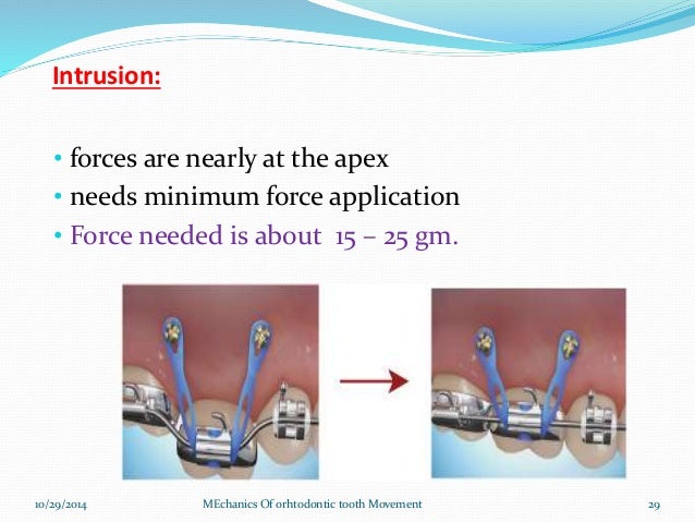 Mechanics of Orthodontic tooth movement