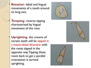 mechanicsoforthodontictoothmovement-200523142932.pptx