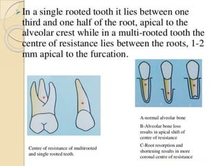 Mechanics of orthodontic tooth movement | PPTX