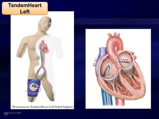 Mechanics of Percutaneous Circulatory Support.ppt