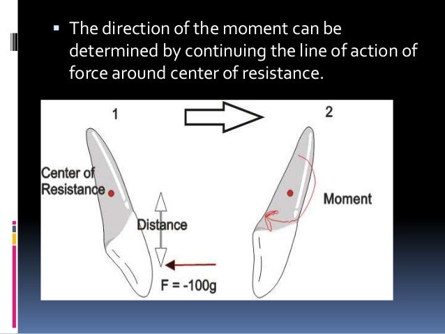 Mechanics of tooth movement