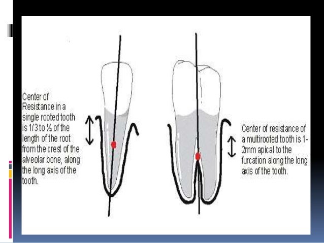 Mechanics of tooth movement