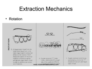 Mechanics sequence for extraction treatment | PPT