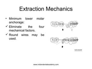 Mechanics sequence for extraction treatment