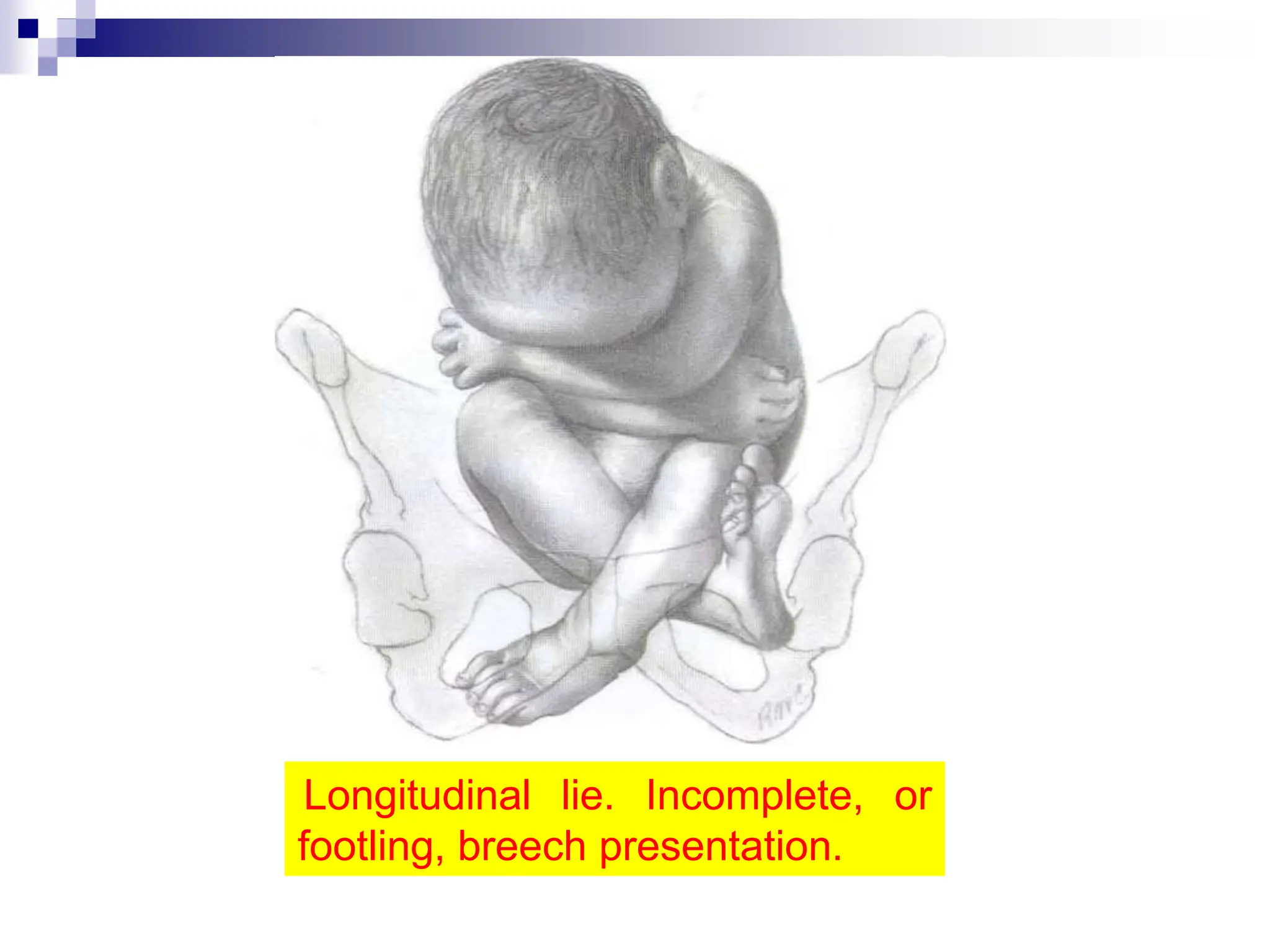 mechanism-of-labour.ppt OBSTETRICS and gynaecologist | PPT