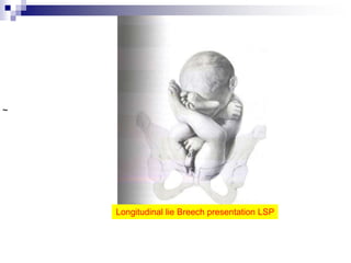 mechanism-of-labour.ppt OBSTETRICS and gynaecologist | PPT