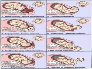 mechanism-of-labour.ppt OBSTETRICS and gynaecologist | PPT