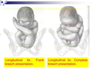 mechanism-of-labour.ppt OBSTETRICS and gynaecologist | PPT